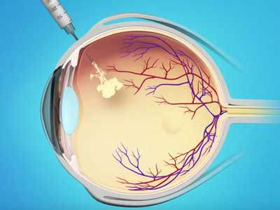 Retinal Vein Occlusion, Retina Services